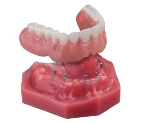 Snap-In Dentures in North Carolina | Carolina Dental Arts