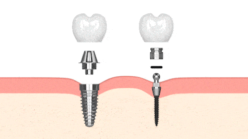 Conventional vs. Mini Dental Implants | Carolina Dental Arts