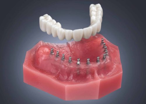 Can You Convert My Denture Into an Implant Denture?