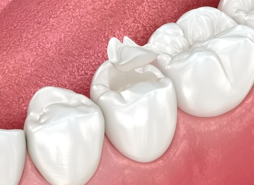 ¿Qué son Inlays y Onlays? | Goldsboro NC Carolina Dental Arts