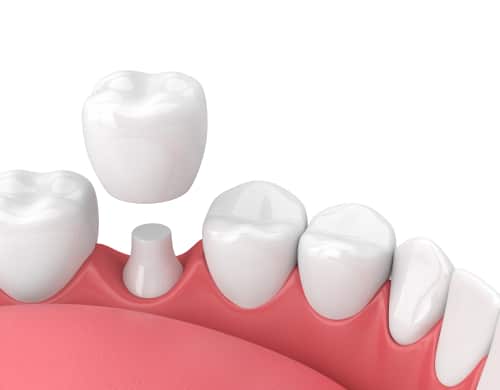 ¿Qué es una corona dental? | Goldsboro, NC Carolina Dental Arts